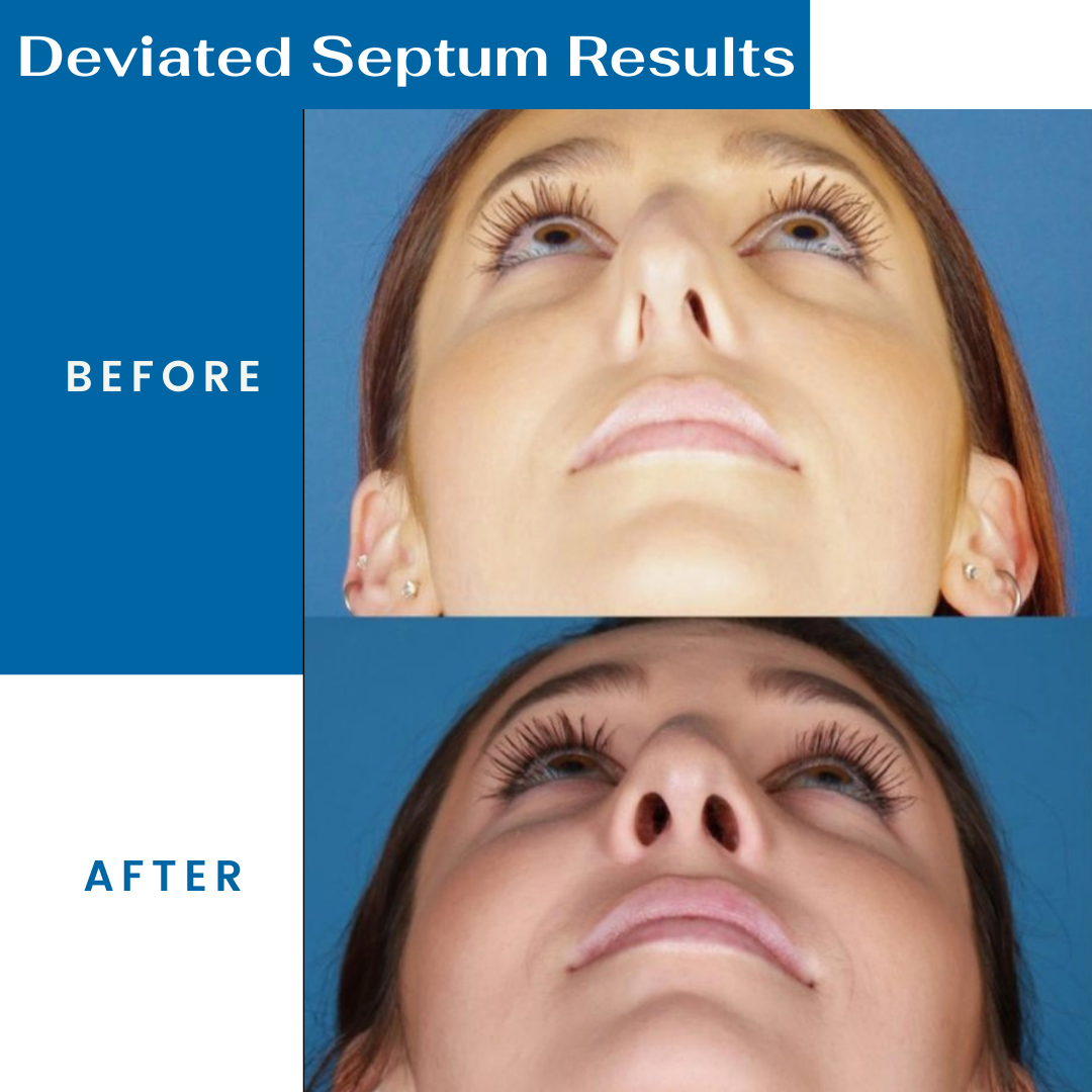 7 Symptoms of a Deviated Septum & How Surgery Might Help