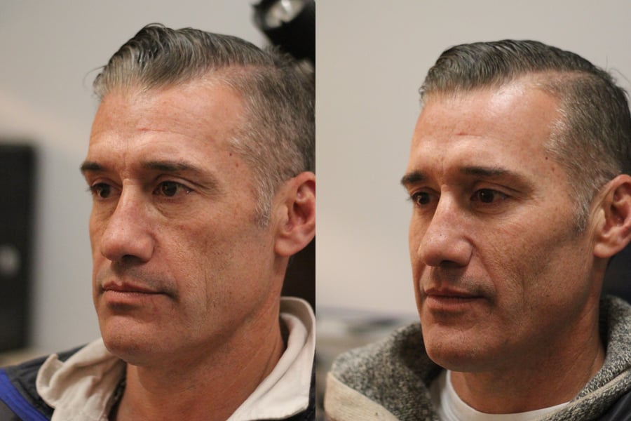 Unique Filler Treatments for Men